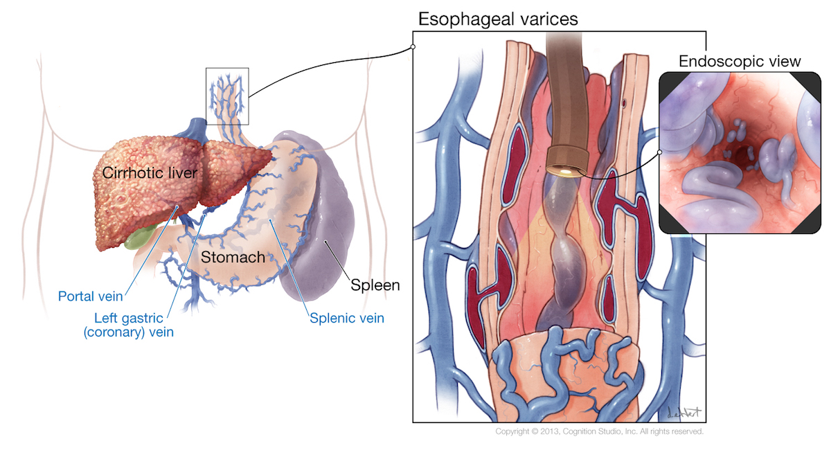 Core Concepts Screening For Varices And Prevention Of Bleeding Management Of Cirrhosis